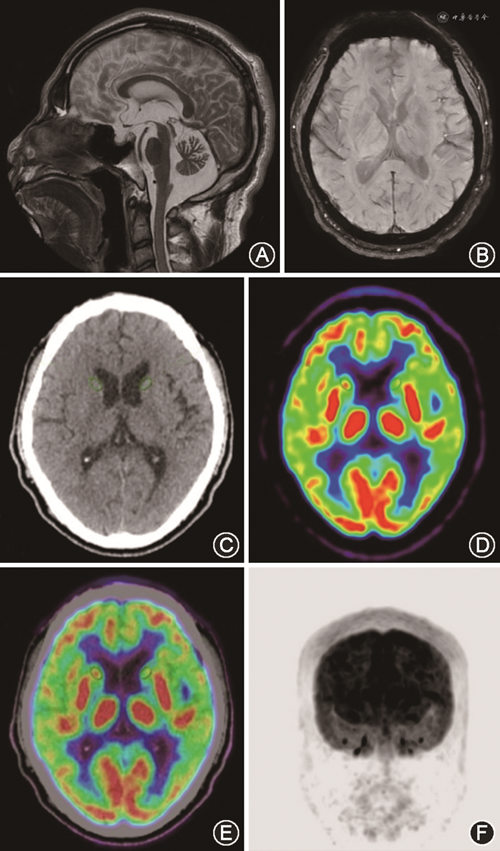 伴小脑萎缩的PLA2G6基因相关早发性帕金森综合征3例 - 中华神经科杂志