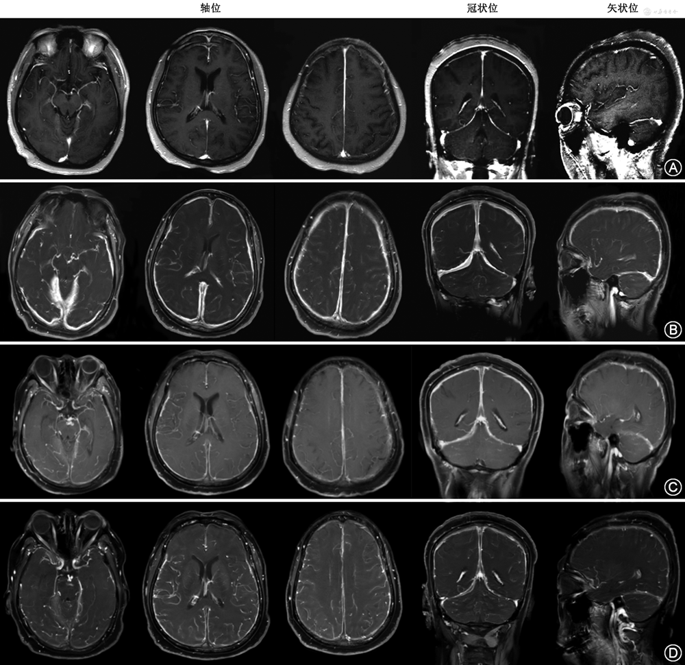IgG4相关肥厚性硬脑膜炎1例 - 中华神经科杂志