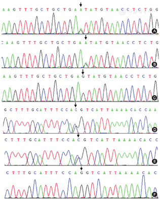 HADH基因突变致先天性高胰岛素血症一例临床分析暨文献复习