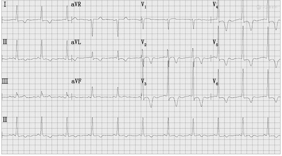 CZT-SPECT动态心肌血流定量显像诊断肥厚型心肌病伴微血管功能障碍1例 - 中华心血管病杂志