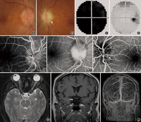 假性Foster Kennedy综合征合并视神经睫状静脉一例
