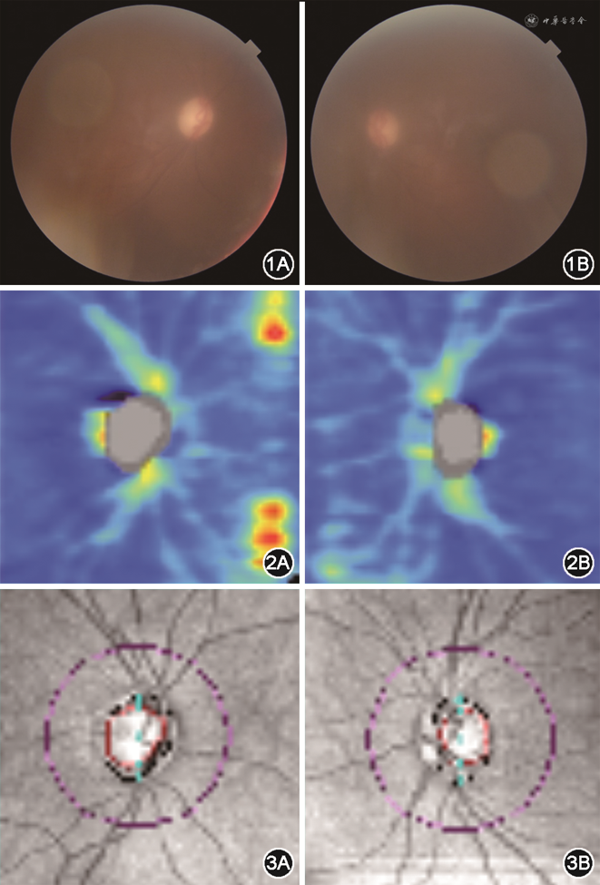 Wolfram综合征2例 - 中华眼科杂志