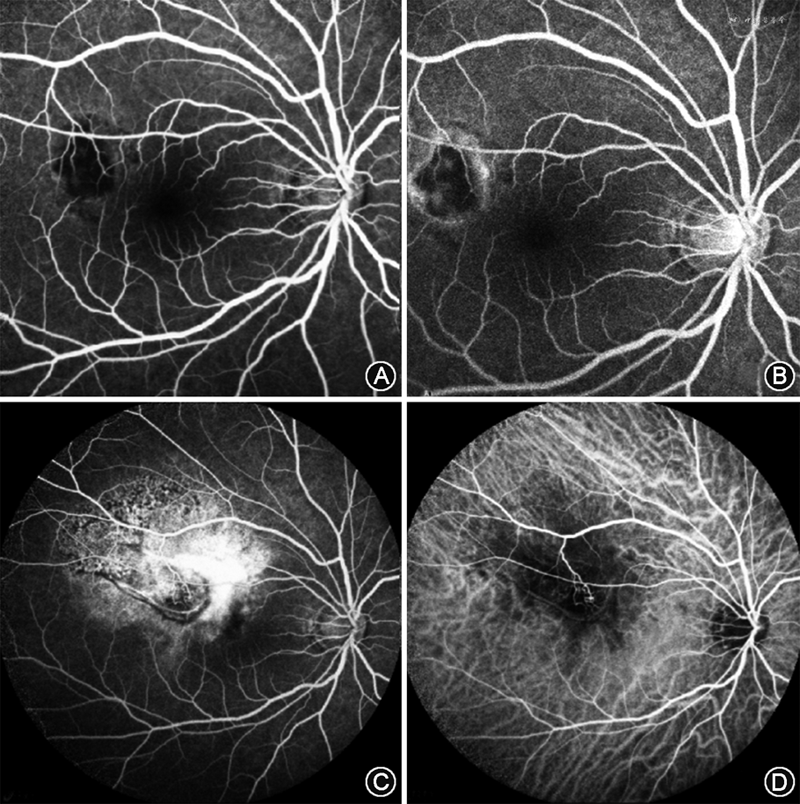 脉络膜结核瘤治疗后矛盾性恶化1例