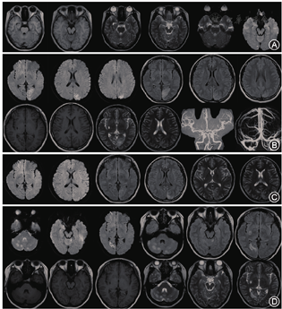 罕见m.10158T>T/C突变致MELAS综合征一例