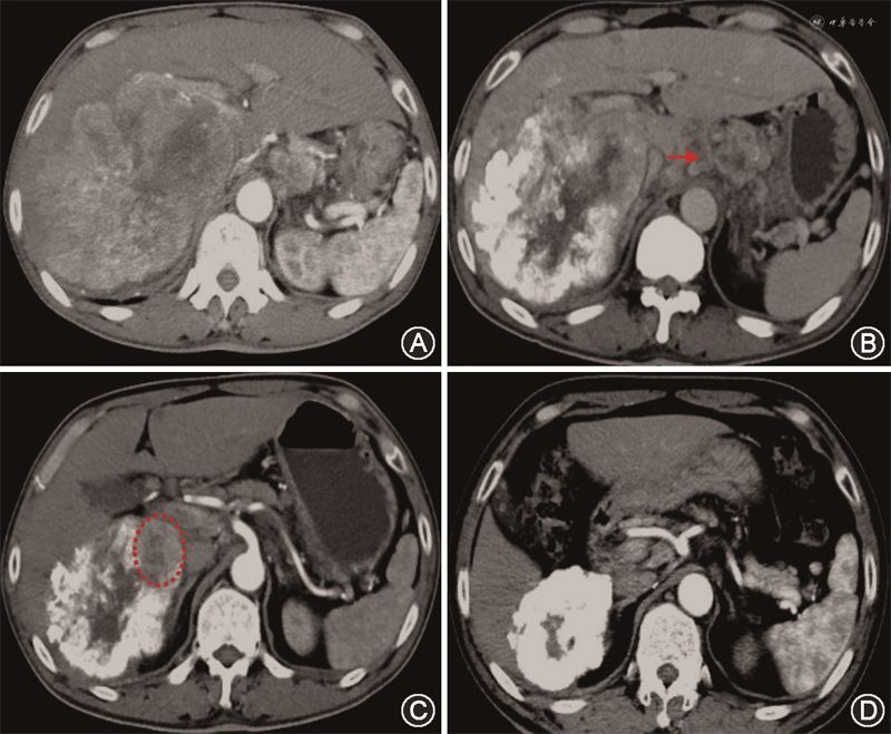 卡瑞利珠单抗联合阿帕替尼治疗D-TACE后进展的中晚期肝癌的初步疗效及安全性分析