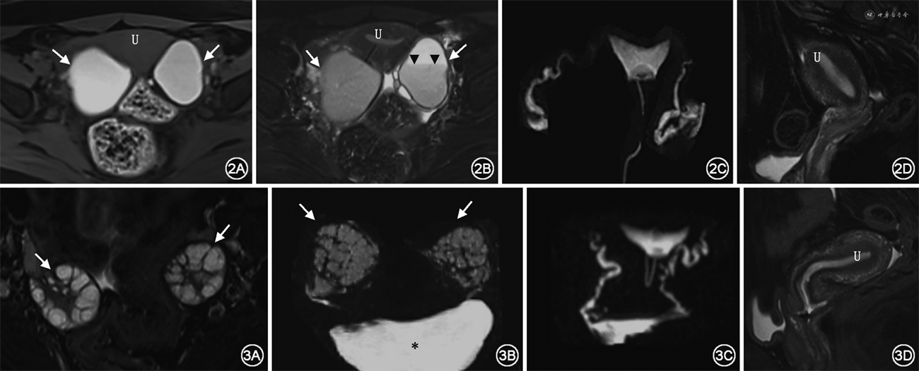 卵巢性不孕症磁共振成像特征及临床病因分析