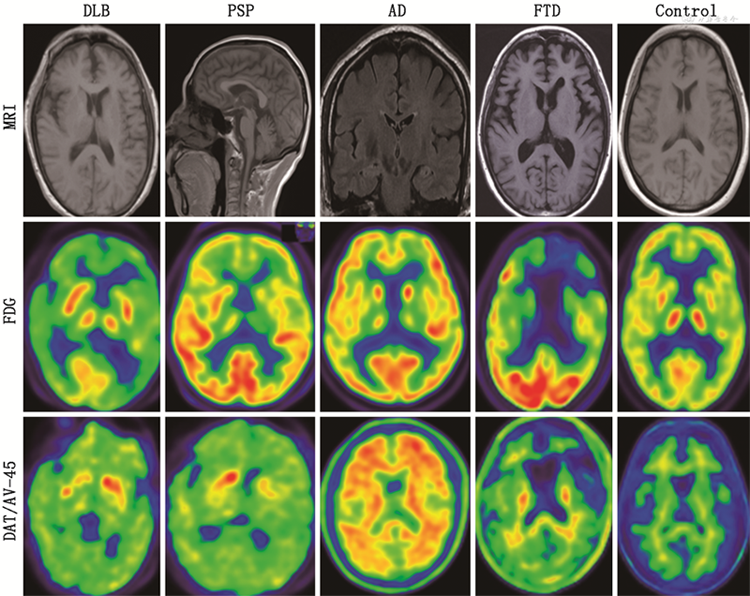 皮肤磷酸化突触核蛋白在路易体痴呆诊断中的应用