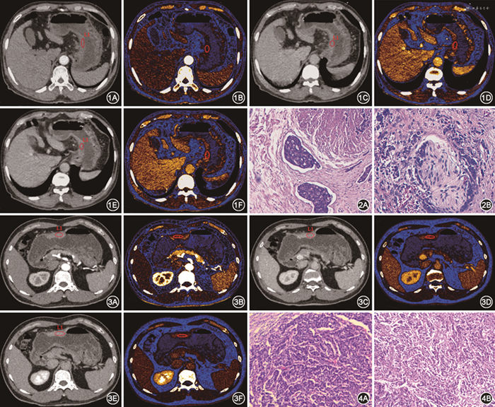 能谱CT多参数成像在术前评估胃癌脉管及神经侵犯状态中的应用价值 - 中华医学杂志