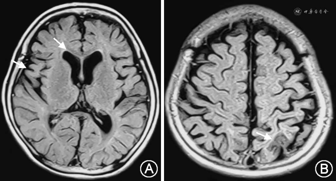 UBTF基因变异导致儿童期起病的神经退行性变伴脑萎缩1例