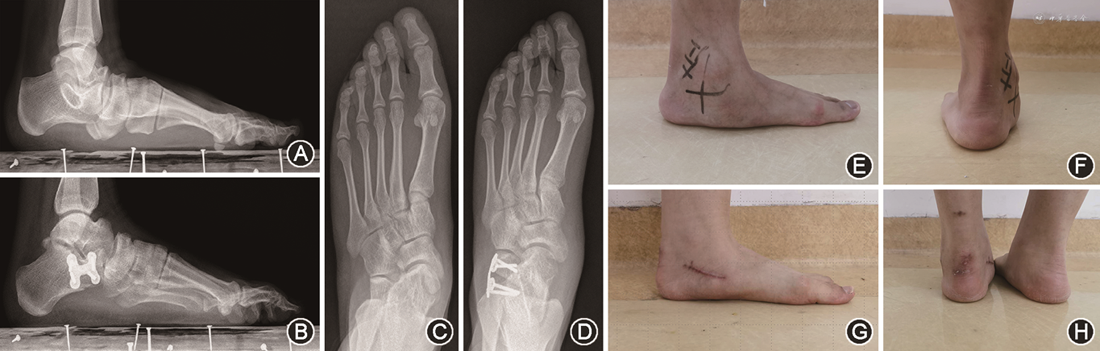 跟骨Hintermann截骨术对柔韧性平足症的疗效观察 - 中华医学杂志