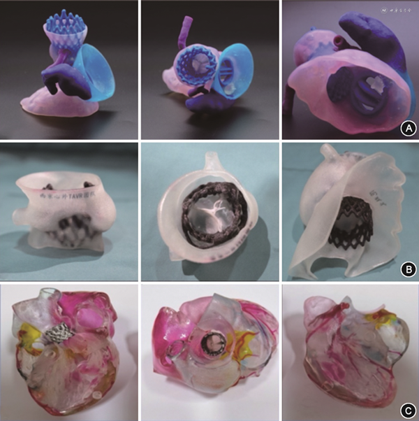 3D打印技术在经导管主动脉瓣置换术中的应用现状与展望