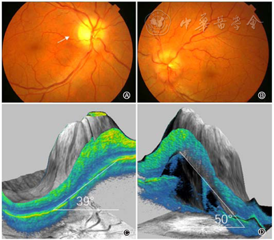 误诊为视神经炎的非经典型Foster Kennedy综合征1例