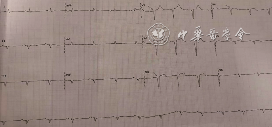 心脏骤停表现的Kounis综合征1例 - 中国综合临床