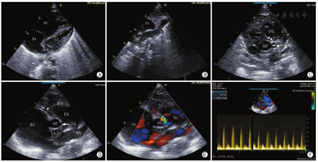 超声诊断梗阻性完全性肺静脉异位引流合并右冠状动脉异常起源于主动脉左冠状窦伴壁内走行1例 - 中华超声影像学杂志