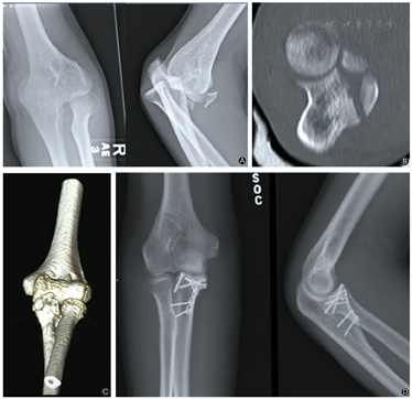 Buttress plate fixation of coronoid process fractures via a medial approach