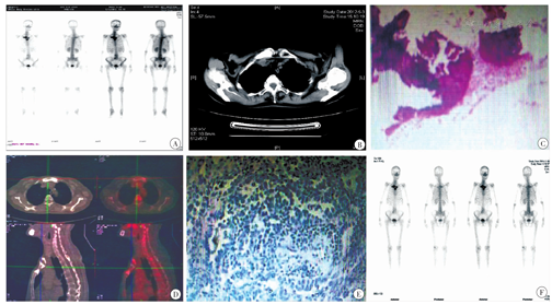 肺腺癌合并SAPHO综合征一例