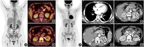 18F－FDG PET/CT诊断巨细胞动脉炎1例 - 中华核医学与分子影像杂志