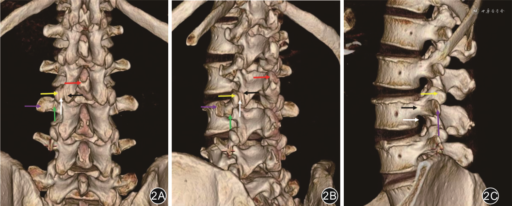 腰椎间盘突出患者腰椎CT三维重建影像的解剖学测量及其在单边双通道内镜手术中的临床意义 - 中华解剖与临床杂志