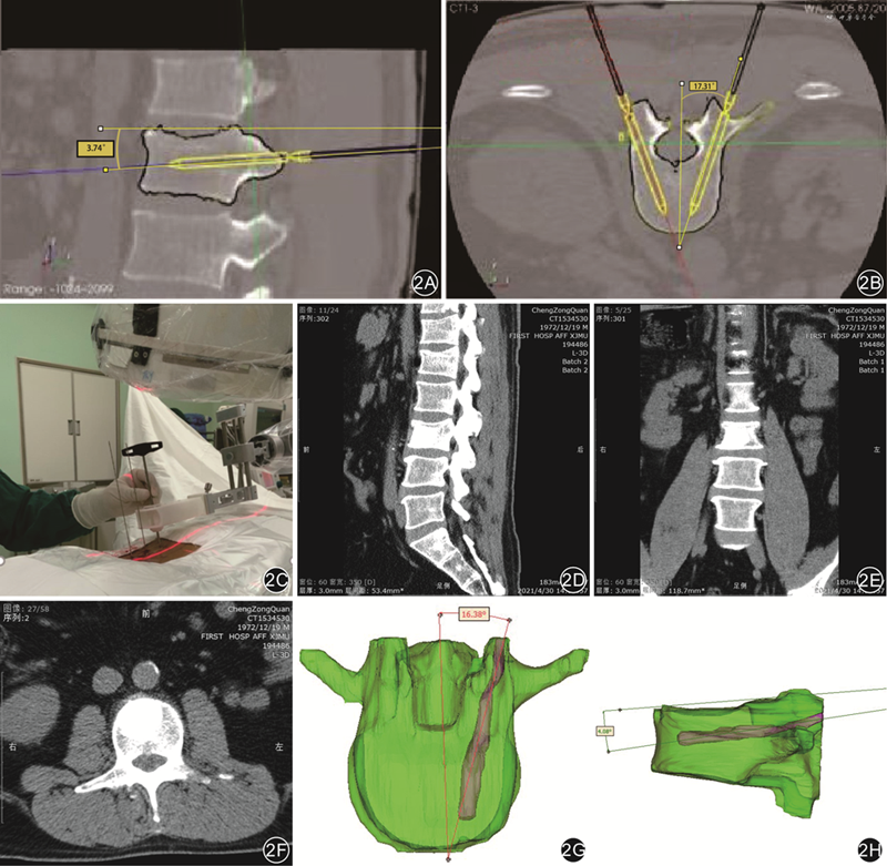 机器人辅助经皮椎体后凸成形术在胸腰椎压缩性骨折治疗中的应用 - 中华解剖与临床杂志