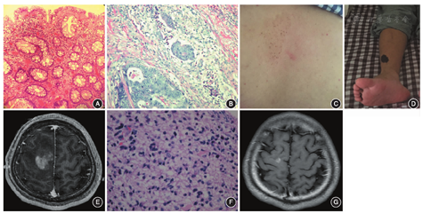 Turcot综合征一例并文献复习
