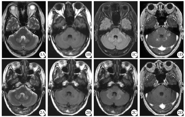 CLIPPERS综合征一例报道并文献复习