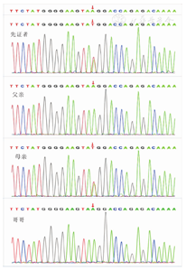PTEN基因新发变异致儿童Cowden综合征1例并文献复习 - 中华实用儿科临床杂志