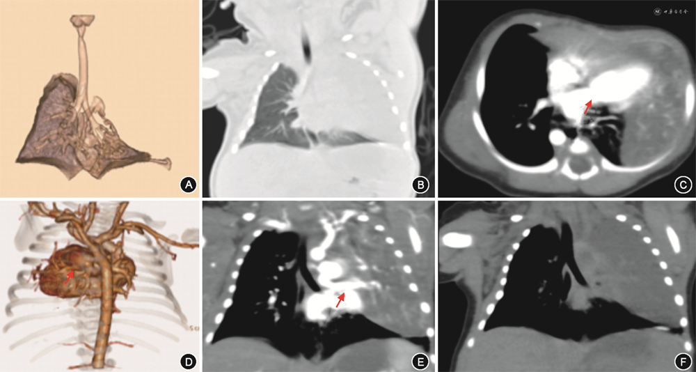 肺动脉供血的先天性叶外型肺隔离症1例 - 中华围产医学杂志