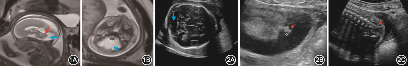 产前诊断胎儿ZTTK综合征1例 - 中华围产医学杂志