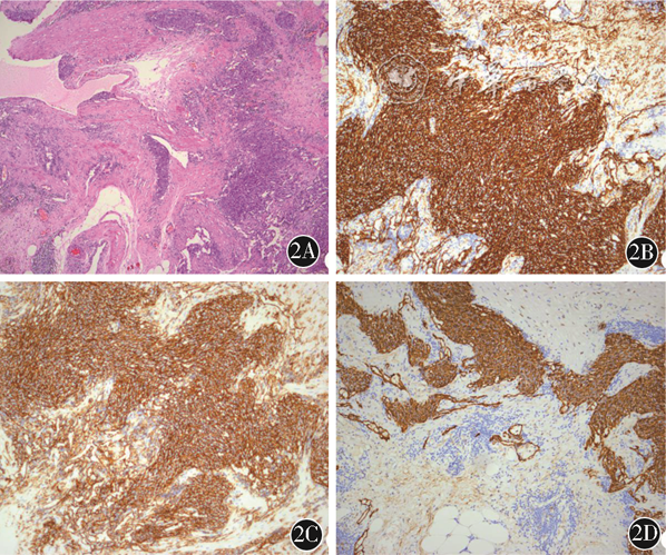 成年人后腹膜卡波西样血管内皮瘤一例