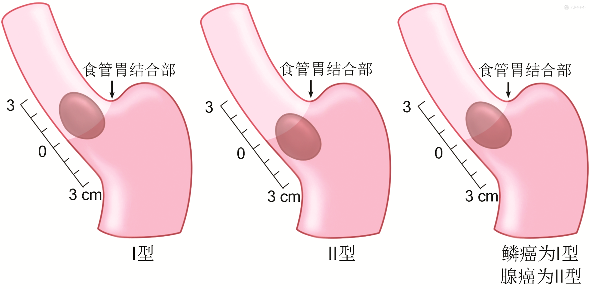 食管胃结合部癌定义与分型的再认识 - 中华消化外科杂志