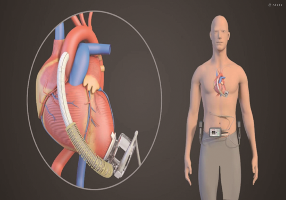 植入式心室辅助装置逆转衰竭心脏重构并撤除1例及文献复习 - 中华心力衰竭和心肌病杂志