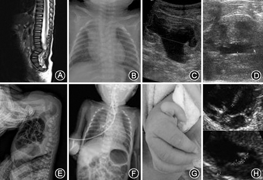 新生儿VACTERL联合征33例临床特点及预后分析 - 中华新生儿科杂志（中英文）