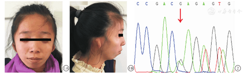 Treacher Collins综合征家系TCOF1基因诊断二例