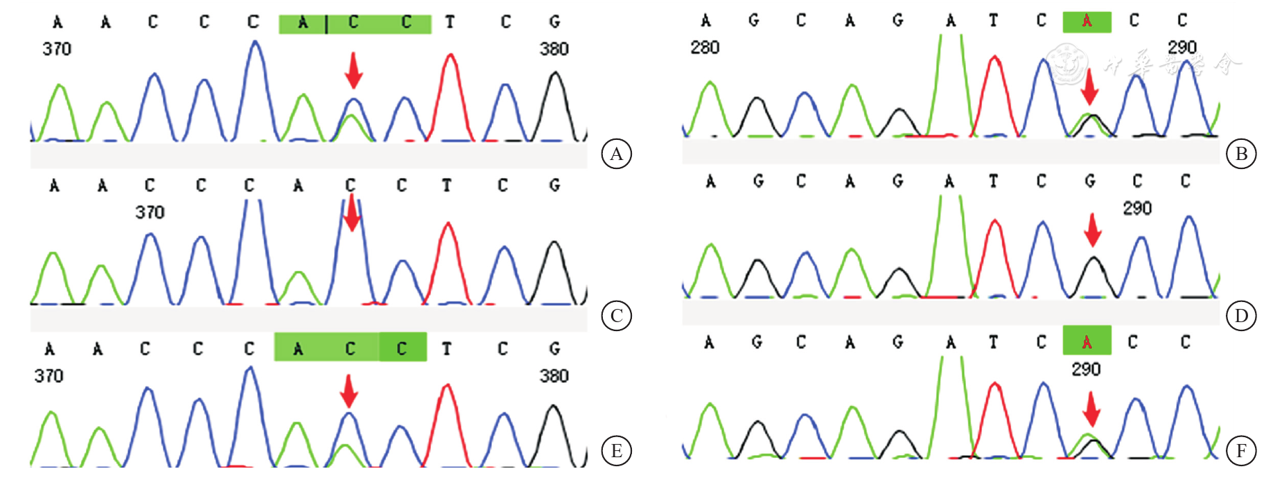 一例3-甲基巴豆酰辅酶A羧化酶缺乏症患儿的MCCC1基因变异分析 - 中华医学遗传学杂志