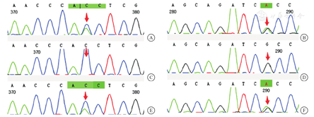 一例3-甲基巴豆酰辅酶A羧化酶缺乏症患儿的MCCC1基因变异分析 - 中华医学遗传学杂志