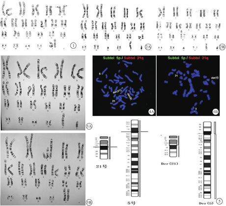 两例无创产前检测提示5号染色体短臂末端微缺失的产前病例的分析 - 中华医学遗传学杂志