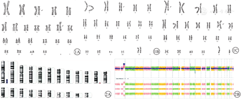 父源性平衡易位致胎儿染色体缺失/重复一例