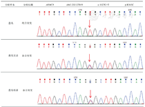 ARMC9基因新变异致Joubert综合征患儿一例 - 中华医学遗传学杂志