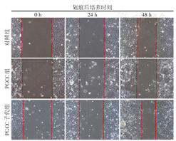 放射诱导的多倍体结肠癌SW1116细胞及其子代细胞增殖、侵袭和迁移能力的改变及相关机制研究 - 肿瘤研究与临床